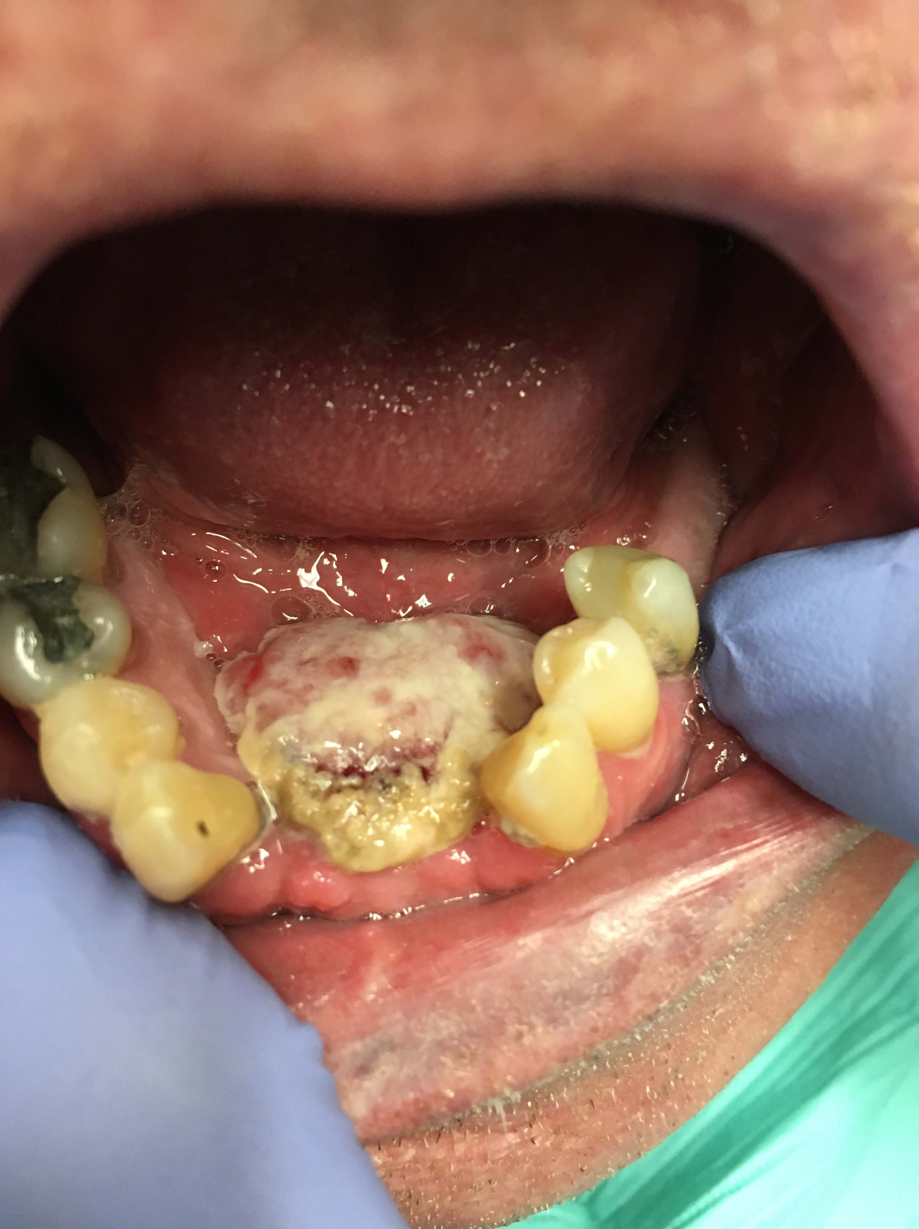Oral Cancer: Lumps, Bumps and Lesions for All Seasons | Concord Seminars