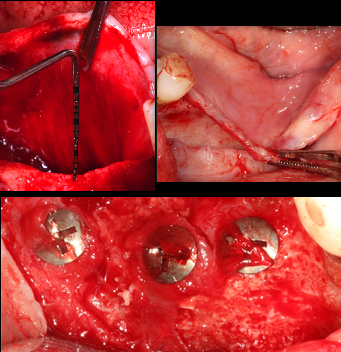 Limitations and Options for Successful Horizontal and Vertical Guided ...